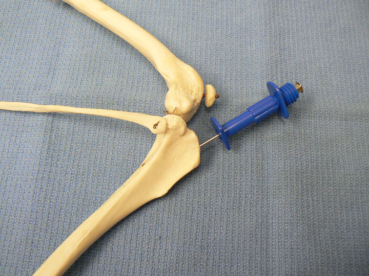 Intraosseous Catheterization: A Life-Saving Tool | Clinician's Brief