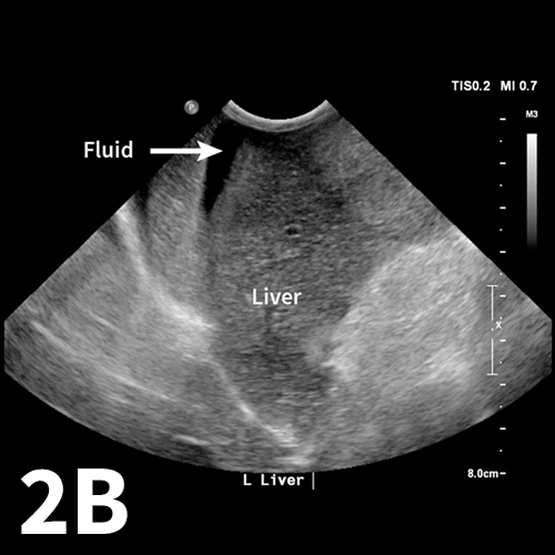 Abdominal Focused Assessment with Sonography for Trauma | Clinician's Brief