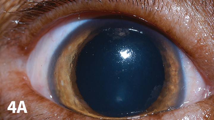 Differentiating Nuclear Sclerosis From Cataracts | Clinician's Brief