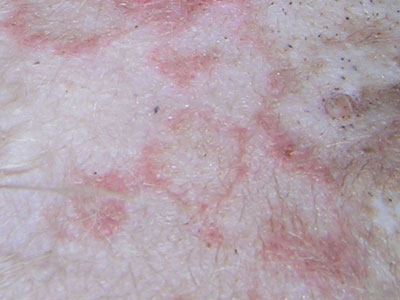 Acute Onset of Skin Lesions in a Dog | Clinician's Brief
