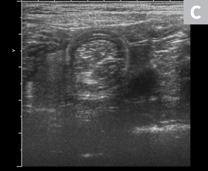 Intussusception Reduction | Clinician's Brief