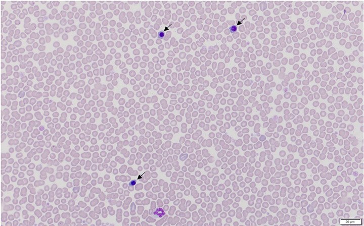 Top 5 Abnormalities Missed When a Blood Film Is Not Examined ...