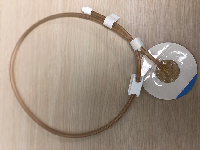 Negative Pressure Wound Therapy for Complicated Elbow Hygroma ...