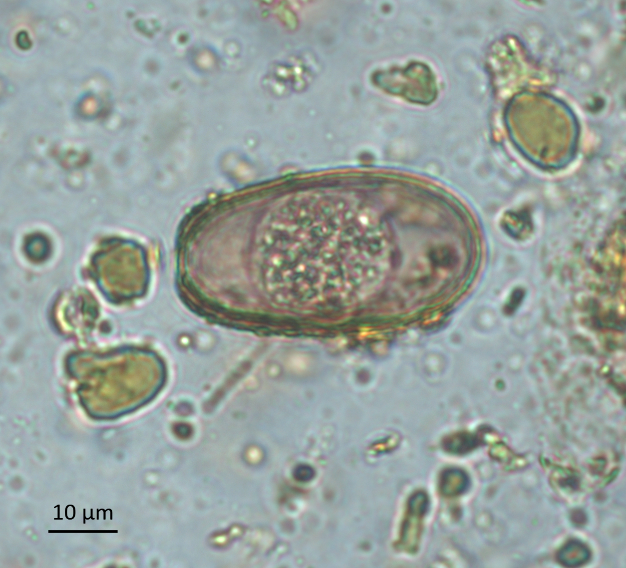 Surprises on Microscopic Fecal Examination | Clinician's Brief