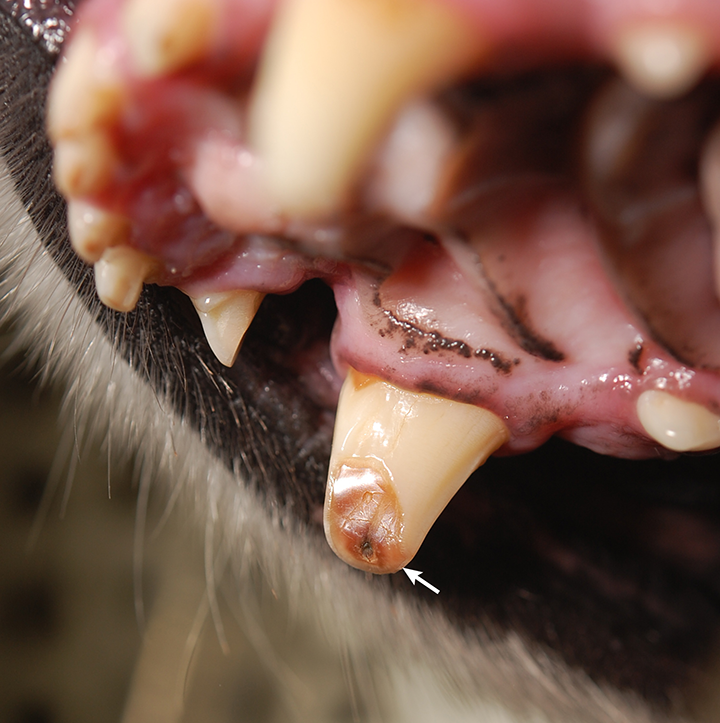 Tooth Fracture | Clinician's Brief