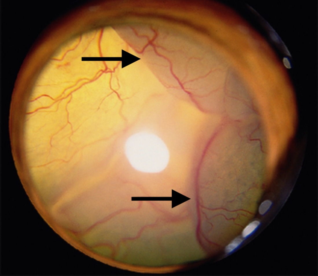 Clinical Image: What Ocular Condition Does This Cat Have?