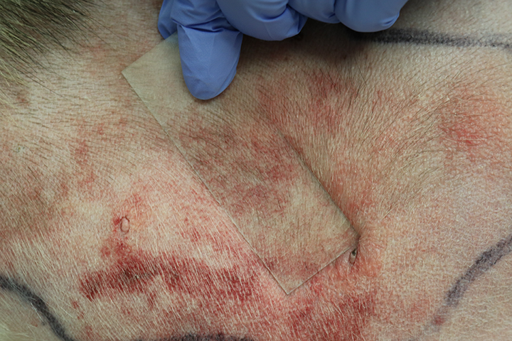 Top 5 Dermatologic Indications for Pentoxifylline in Dogs | Clinician's ...