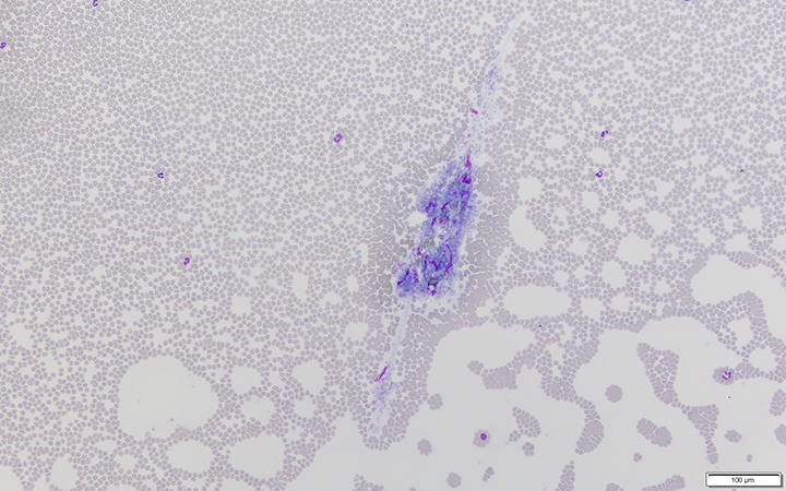 Reduction of Pseudothrombocytopenia in EDTA-Anticoagulated Blood