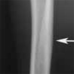 Hairline Bone Fracture | Clinician's Brief