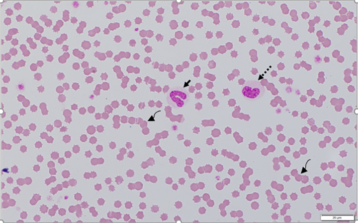 An Abnormal Peripheral Blood Smear And Altered Mental, 55% OFF