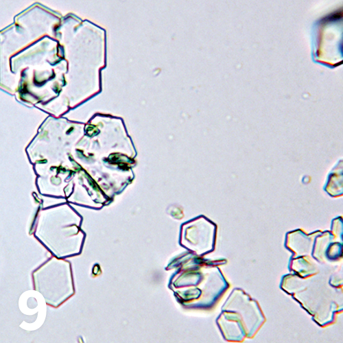 Cystine Crystals In Urine
