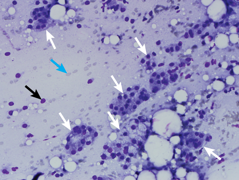 Top 5 Cytologic Findings in Aspirates of Enlarged Lymph Nodes ...