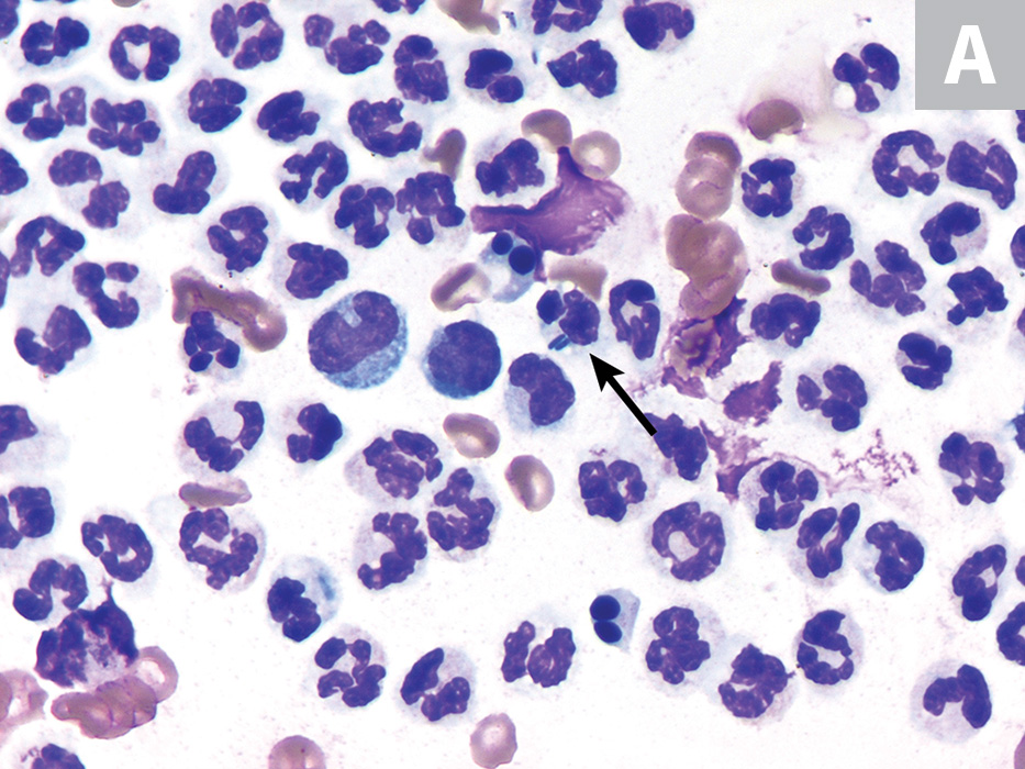 Effusion Cytology | Clinician's Brief
