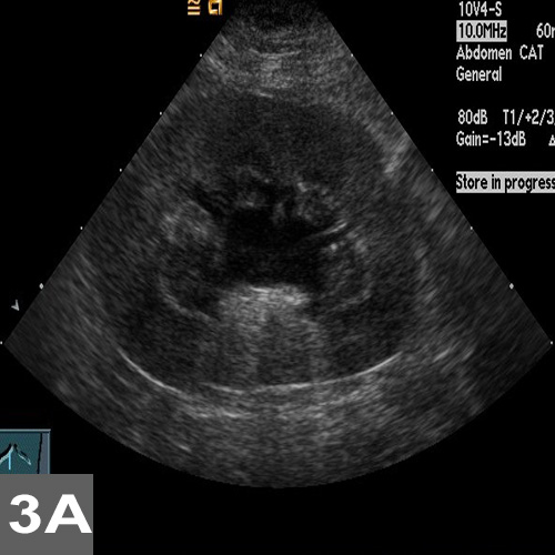 Managing the E coli UTI | Clinician's Brief