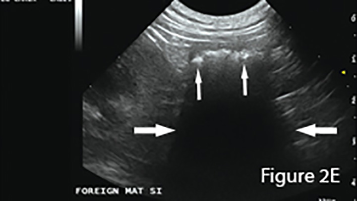 Imaging Intestinal Obstruction | Clinician's Brief