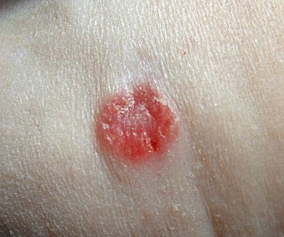 Clinical Image: Primary Skin Lesion