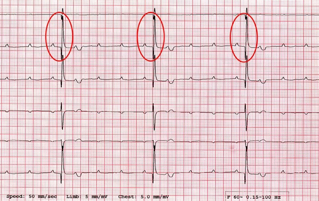 Clinical Image: What Arrhythmia Is Identified?