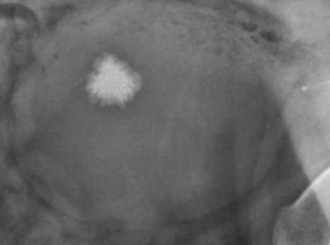 Clinical Image: Bladder Stone