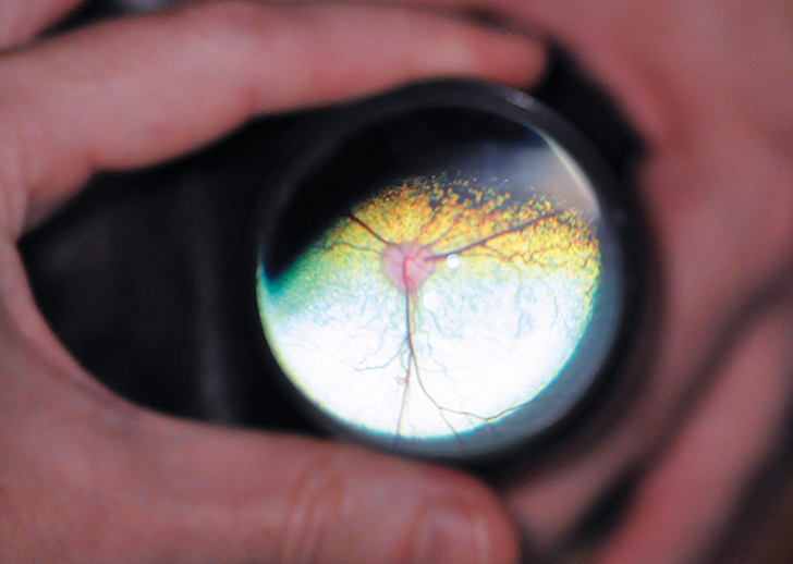 Fundic Examination | Clinician's Brief