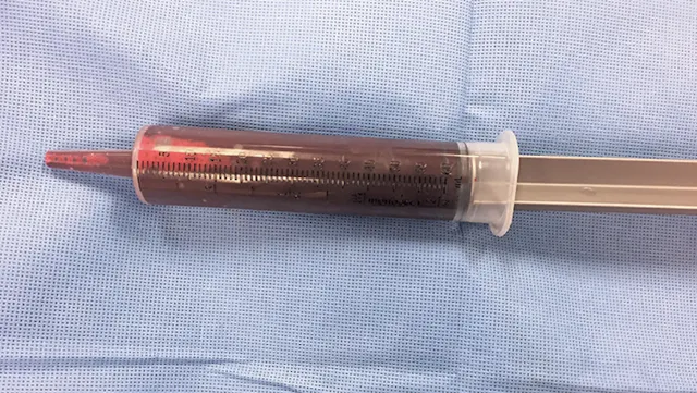 Emergency Autotransfusion