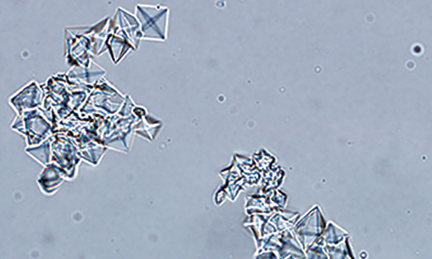 Urinalysis With Microscopic Light Microscopic Analysis Of Urine