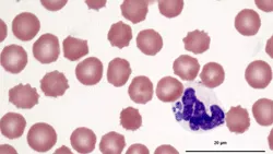 What Your Hematology Analyzer Can't Tell You