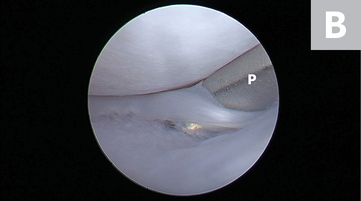 Meniscal Disease | Clinician's Brief