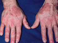 Itchy Skin Rash On Hands Itchy Skin Rash On Hands