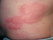 Covid Rash Lip Swelling In Dogs Causes And Treatment Infoupdate Covid Rash Lip Swelling In Dogs Causes And Treatment Infoupdate