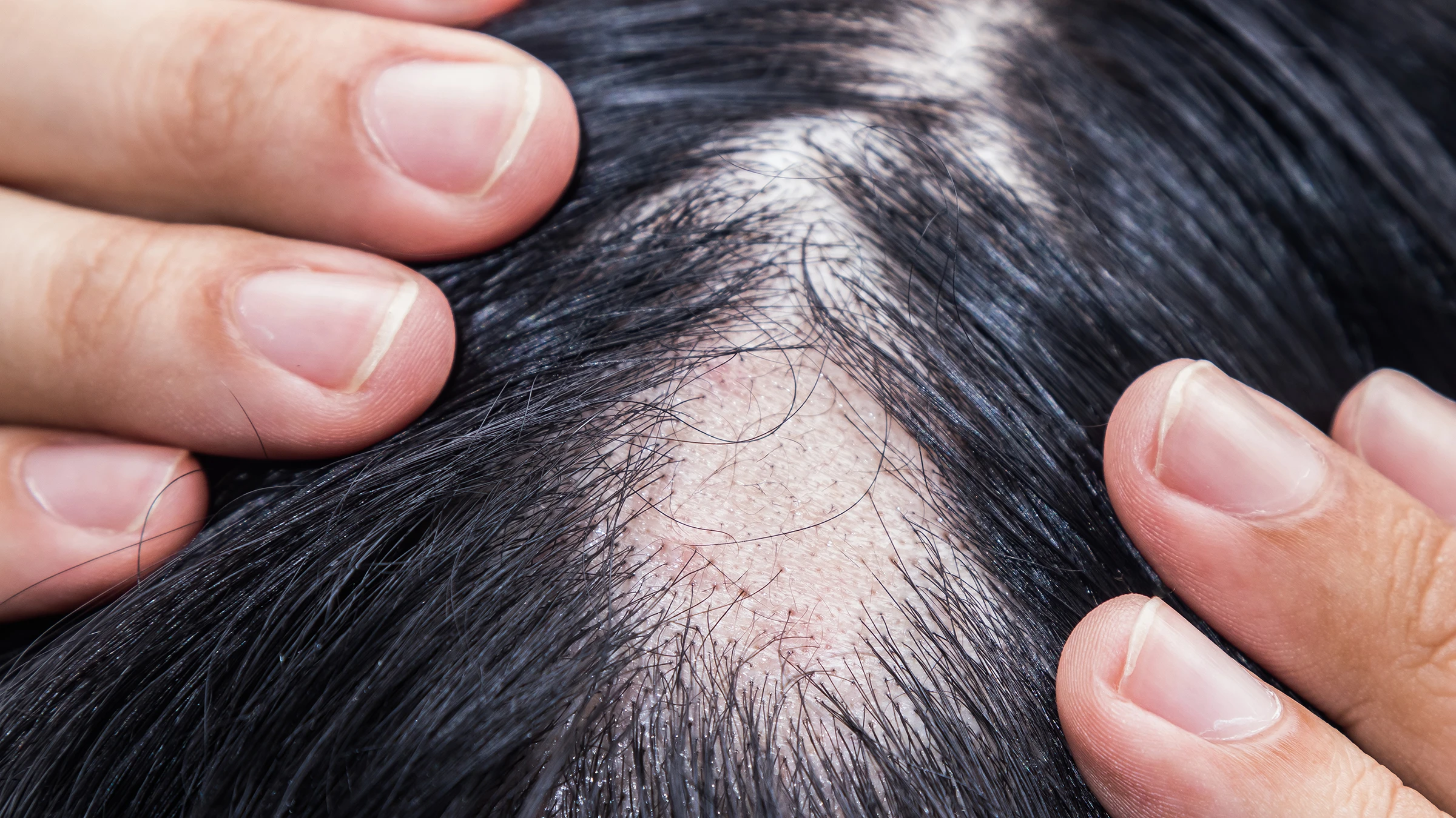 Telogen Effluvium: Causes, Images, and Treatments - GoodRx