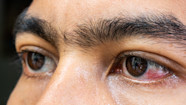 Can Bloodshot Eyes Be Serious 10 Symptoms To Be Aware Of GoodRx