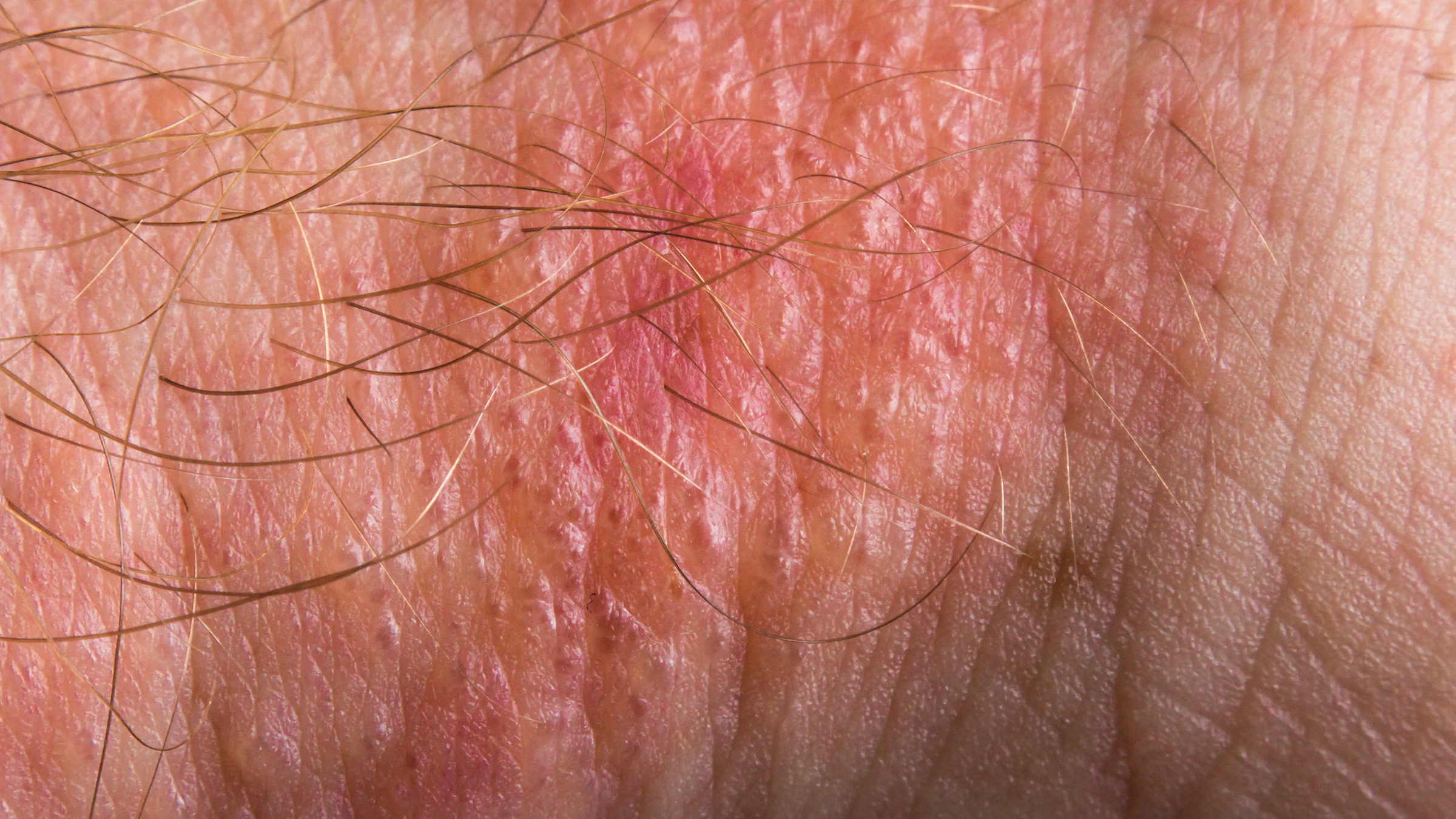 What Does Poison Ivy Rash Feel Like - Infoupdate.org