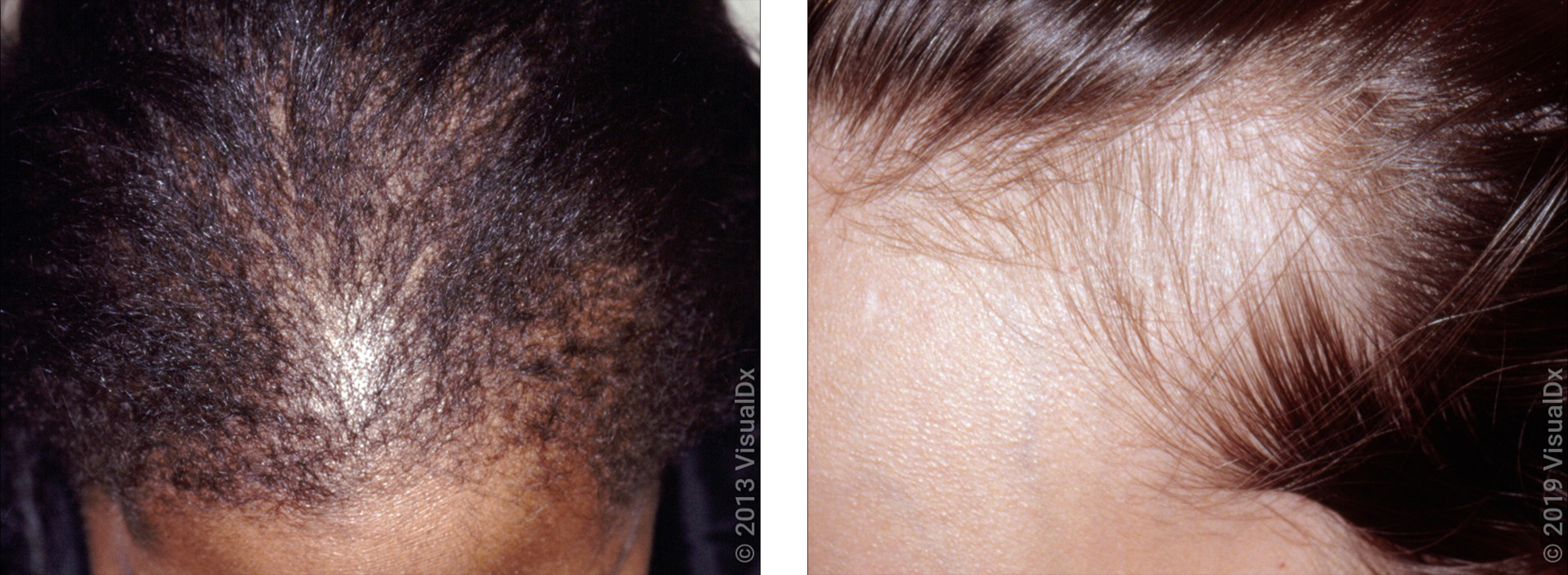 How long does telogen effluvium last store