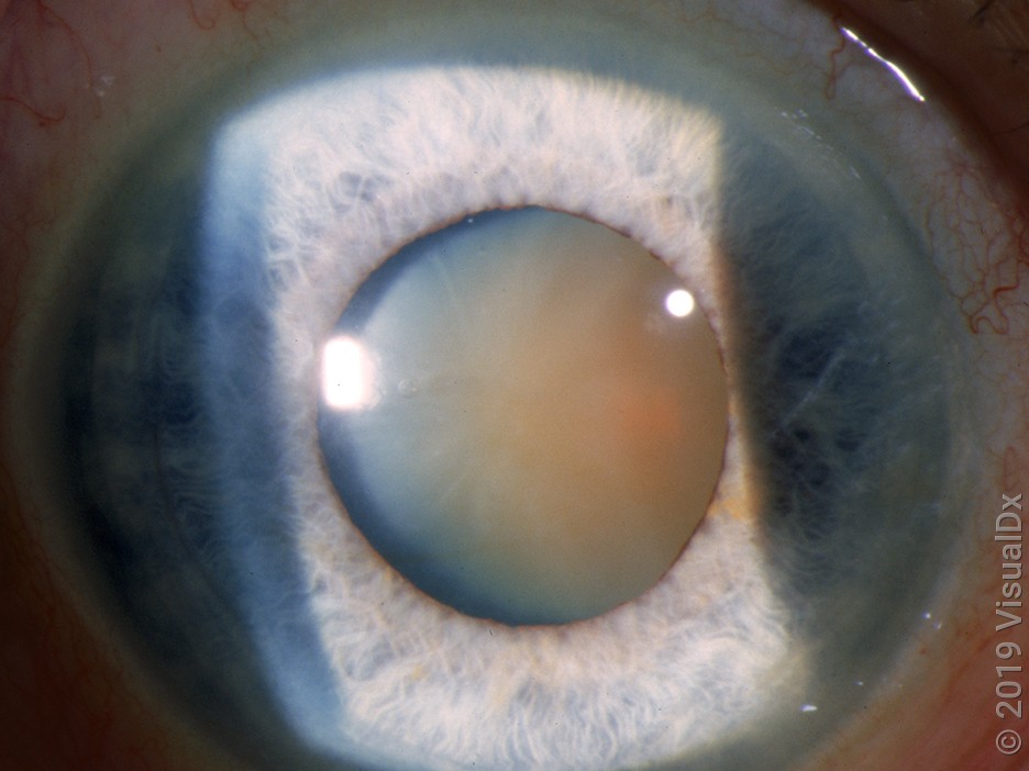 What Do Cataracts Look Like? Pictures and Symptoms - GoodRx
