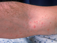 Scabies On Arms Scabies On Arms