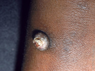 Skin Cancer Small Dark Spot Infoupdate Skin Cancer Small Dark Spot Infoupdate