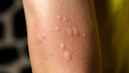 Hives Getting Worse Instead Of Better Causes And Treatment GoodRx