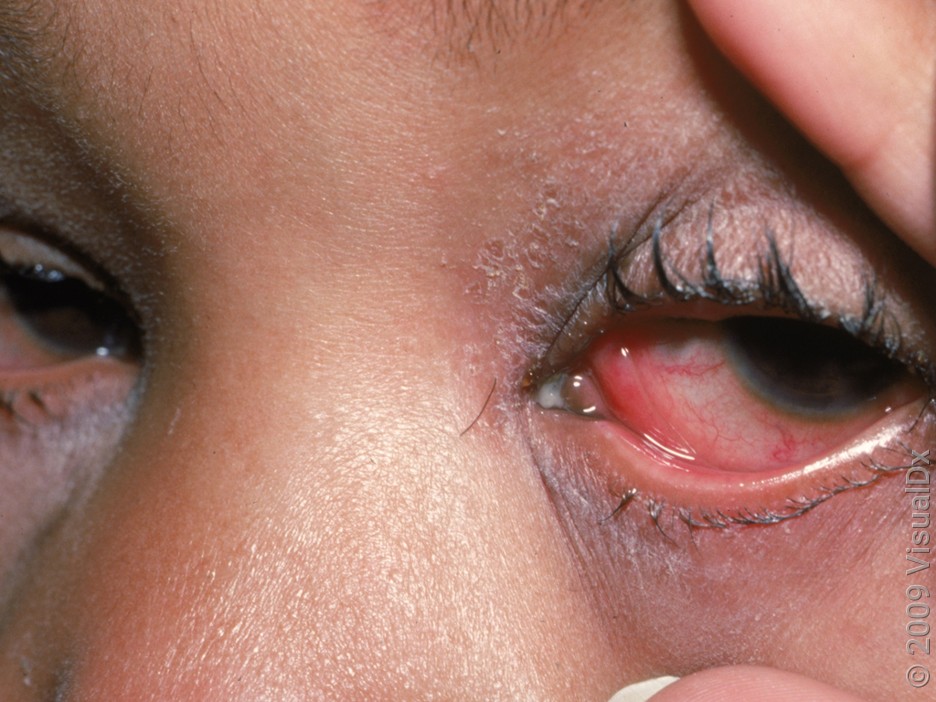 How Long Does Pink Eye Last? Pictures and Recovery Tips - GoodRx