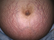 What Do Stretch Marks Look Like GoodRx What Do Stretch Marks Look Like GoodRx