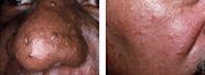 Small Red Spots On Face Not Acne Infoupdate Small Red Spots On Face Not Acne Infoupdate