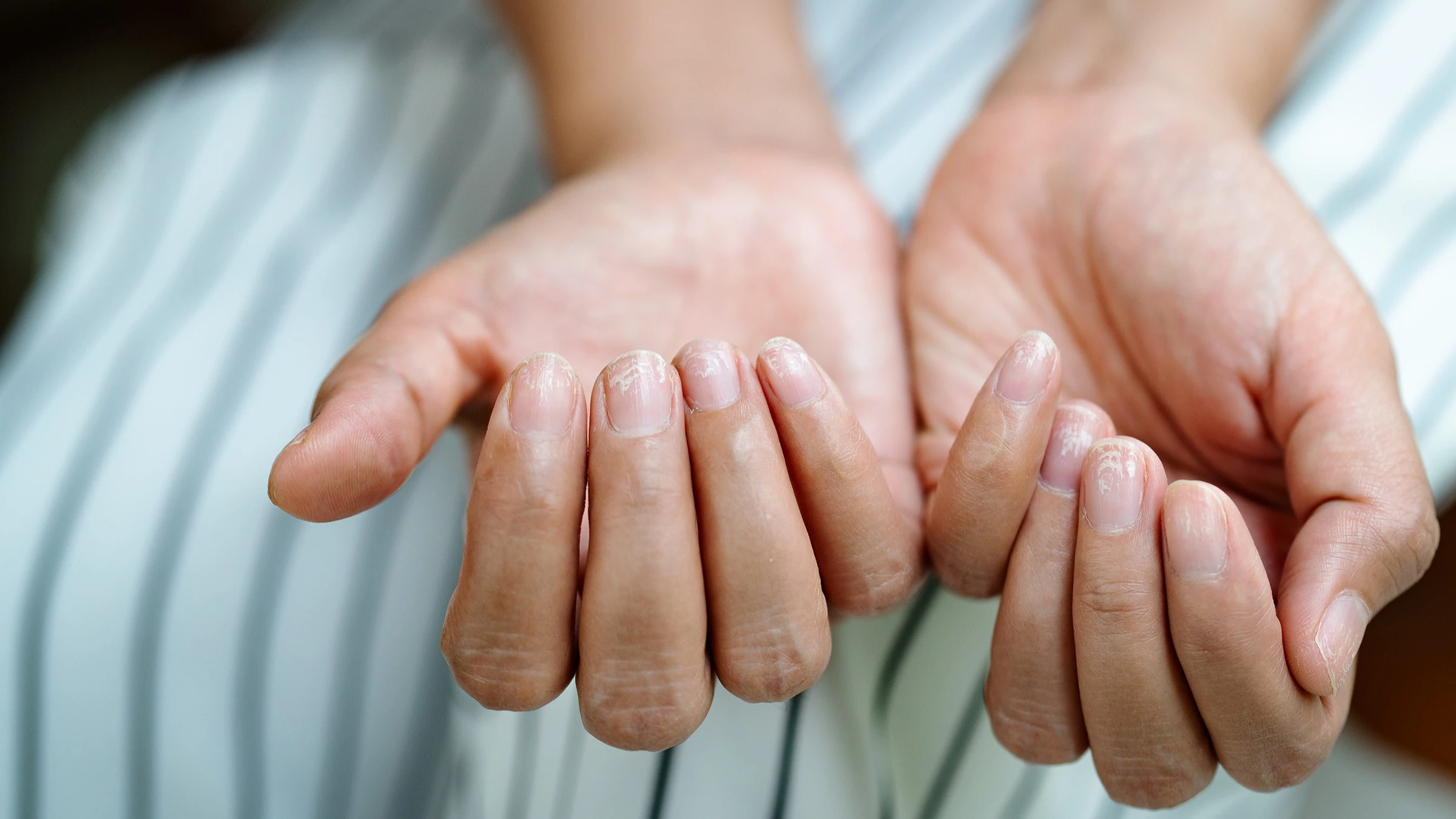 8 Psoriatic Arthritis Nail Symptoms (With Pictures) - GoodRx