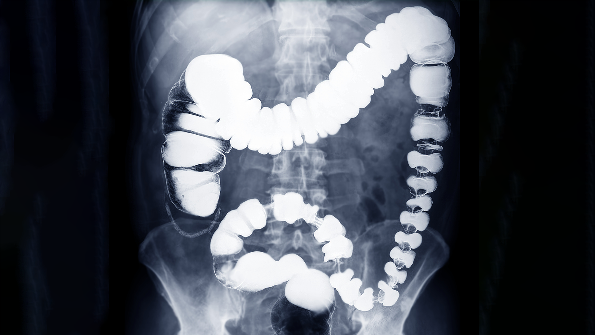 What Is Rectal Cancer? And How Is It Different Than Colon Cancer? - GoodRx