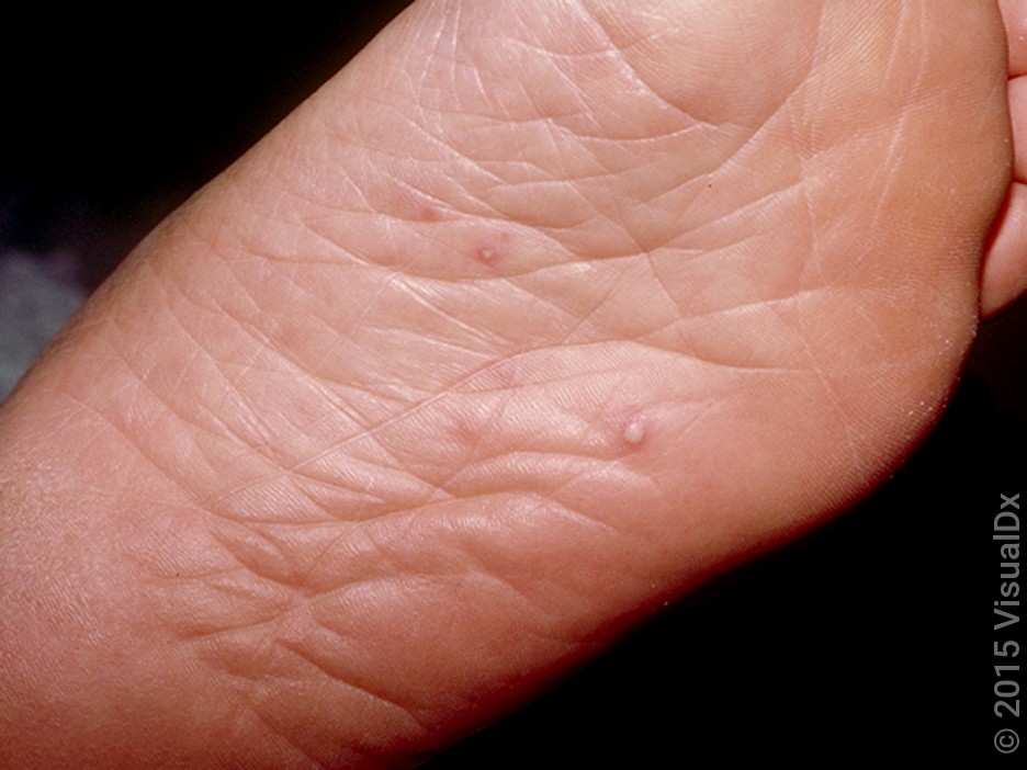 Symptoms of hand foot and mouth in adults store