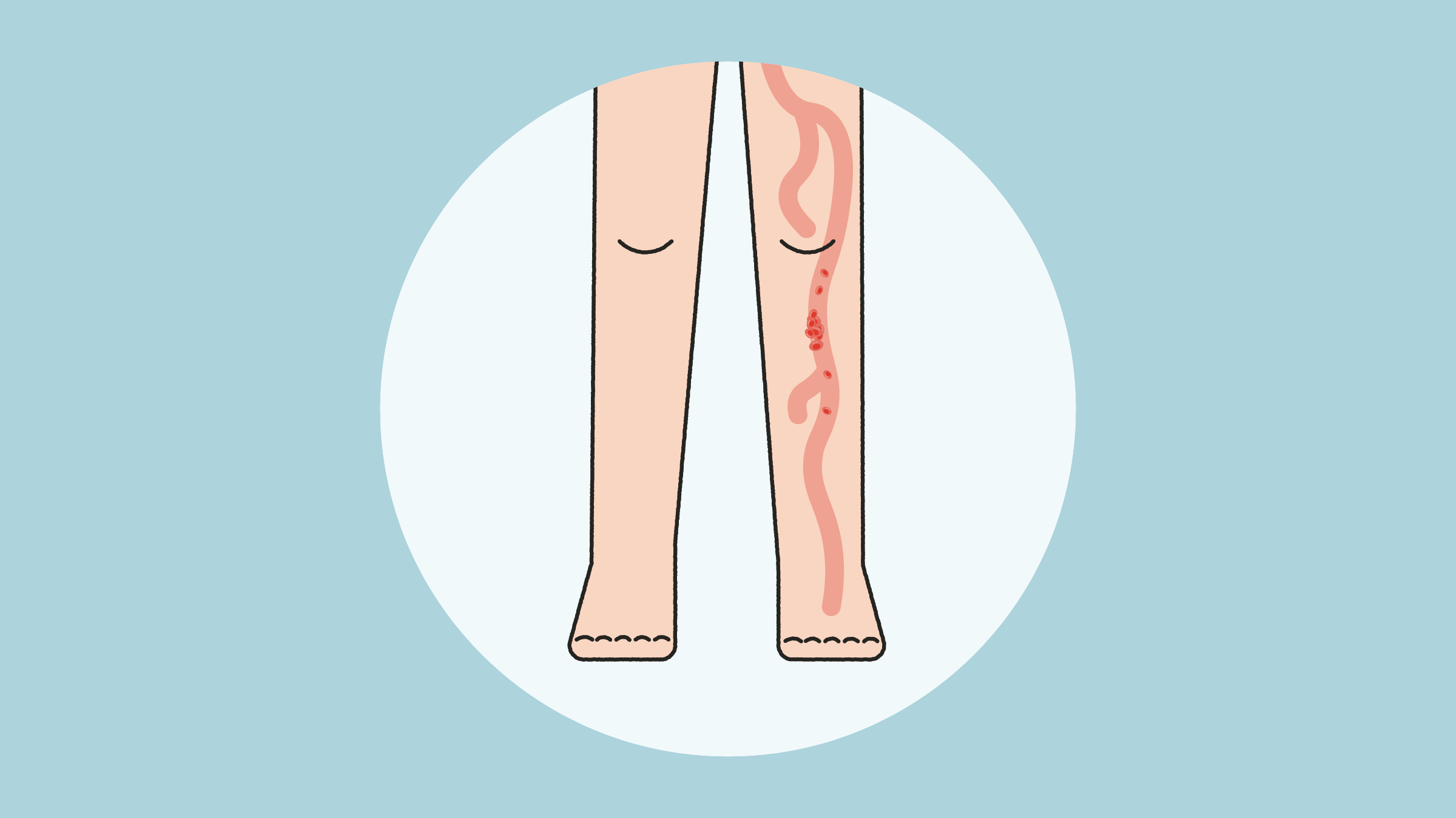 Do I Have DVT? Take the Quiz - GoodRx