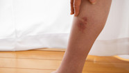 What Is Erythema Nodosum Is It An Autoimmune Disorder GoodRx What Is Erythema Nodosum Is It An Autoimmune Disorder GoodRx
