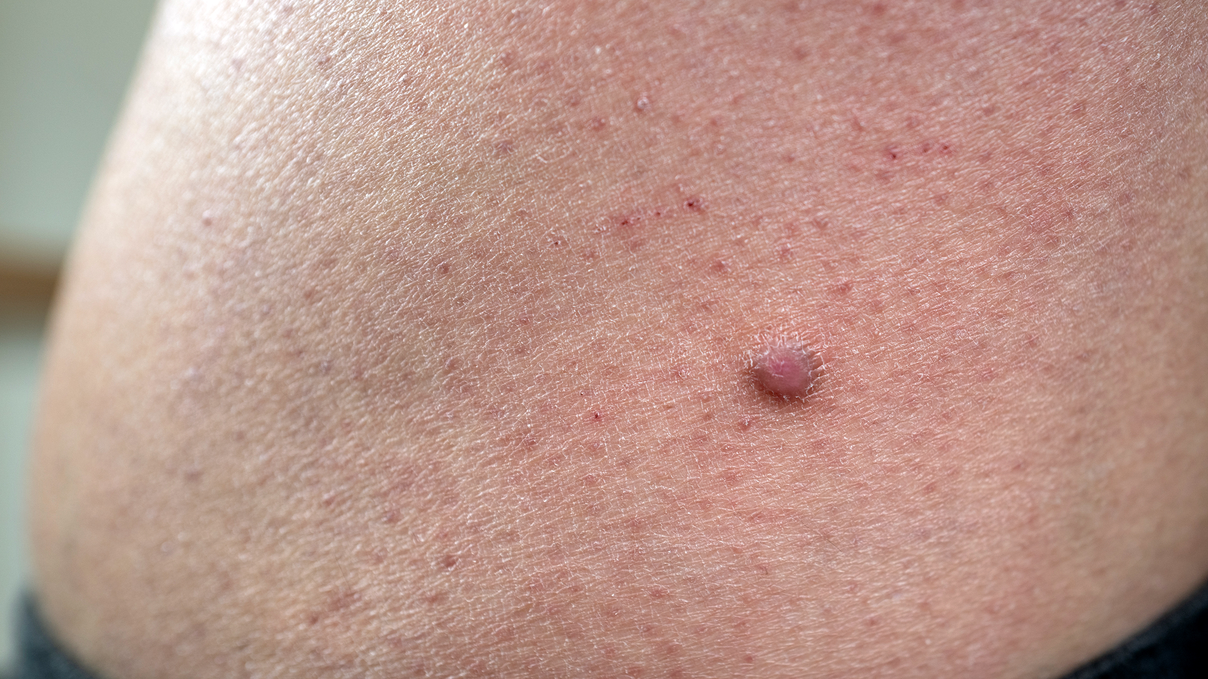 Dermatofibroma: Pictures, Causes, and Removal - GoodRx