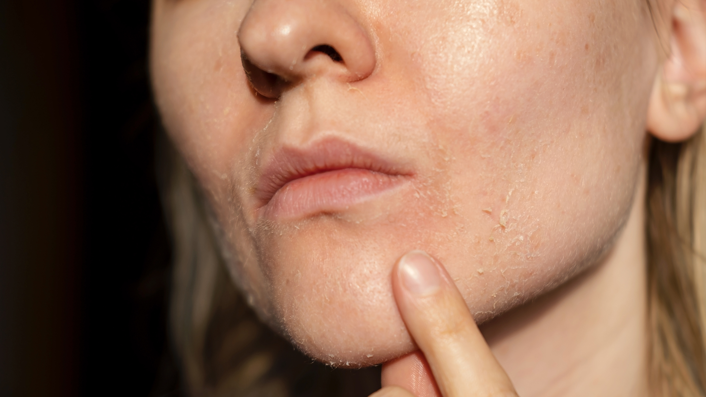 Can Dry Skin Cause Acne No But It Can Increase Your Risk Goodrx