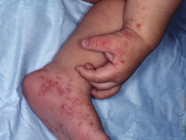 What Causes Red Spots On A Child Infoupdate What Causes Red Spots On A Child Infoupdate