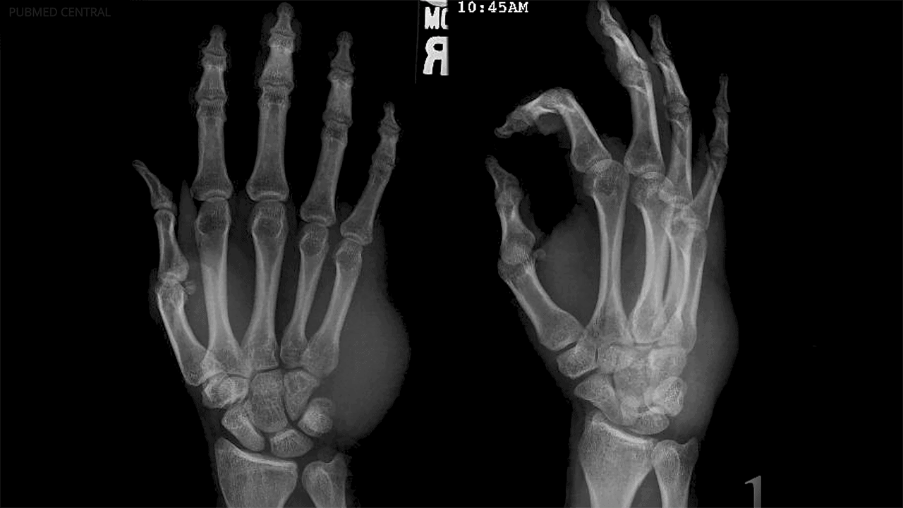 Diagnosing Soft Tissue Sarcoma: What Doctors Look For - GoodRx