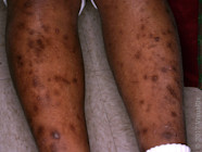 Photos Of Bed Bug Bites On African American Skin Infoupdate Photos Of Bed Bug Bites On African American Skin Infoupdate